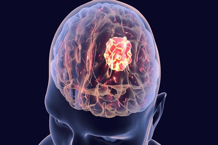 Akciğer Nereye Metastaz Yapar? - Güncel Oku