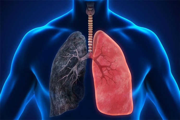 Akciğerde Şişlik Neden Olur? - Güncel Oku
