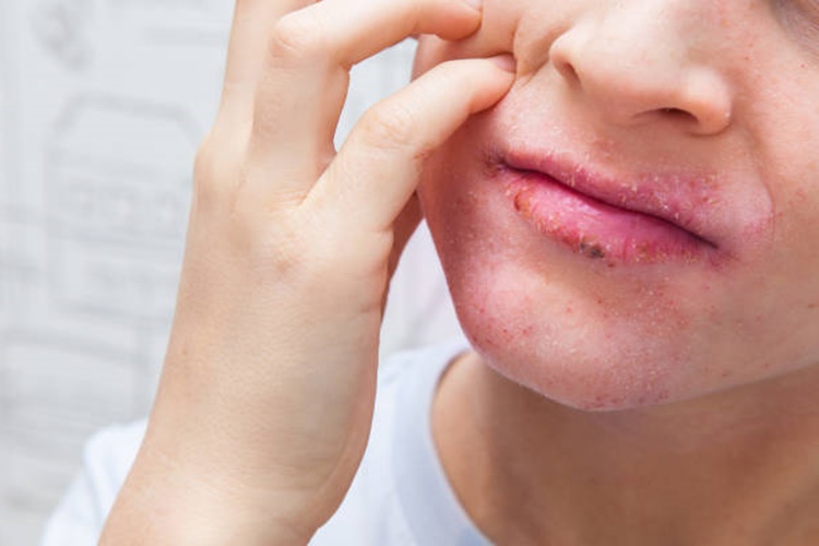 Antibiyotik Alerjisi Kaç Dakikada Belli Olur? - Güncel Oku