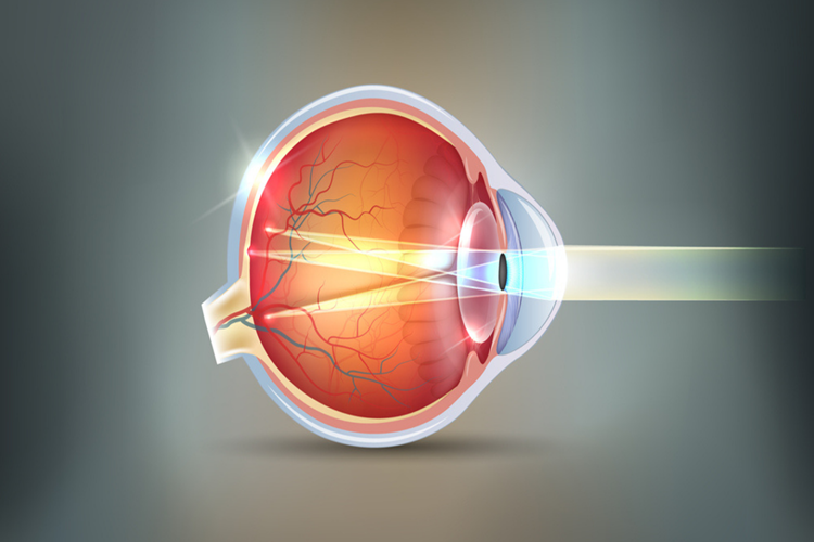 Astigmat Nasıl Tedavi Edilir? - Güncel Oku