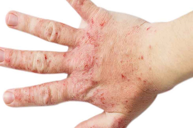 Atopik Dermatit Hastalığı Nelere Yol Açar? - Güncel Oku