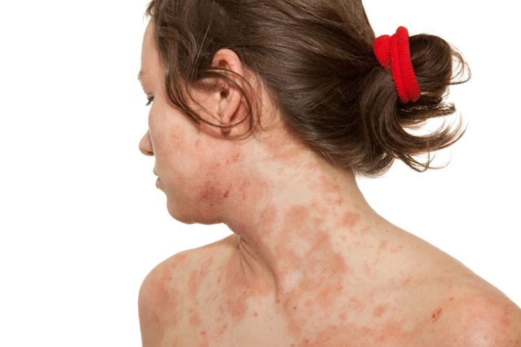 Atopik Dermatit Nedir? - Güncel Oku