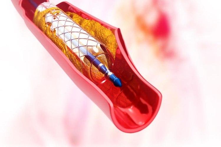 Bacağa Stent Takıldıktan Sonra Morarma Olur Mu? - Güncel Oku