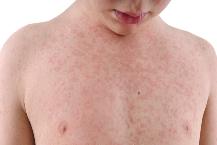 Bebeklerde Alerji Uykusuzluk Yapar Mı? - Güncel Oku