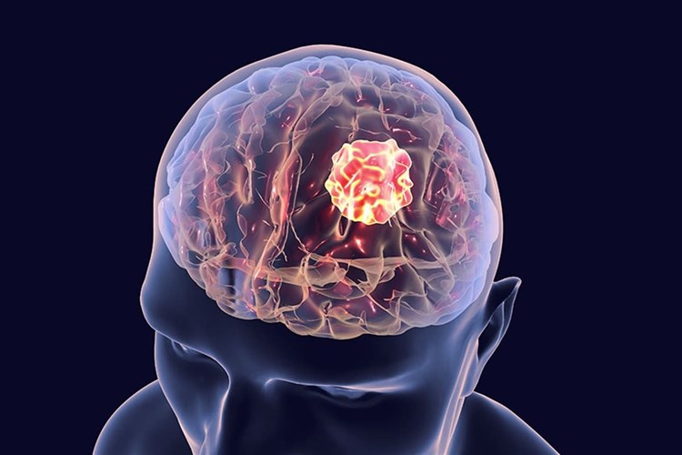 Beyin Tümörü Ameliyatı Olanlar Malulen Emekli Olabilir Mi? - Güncel Oku