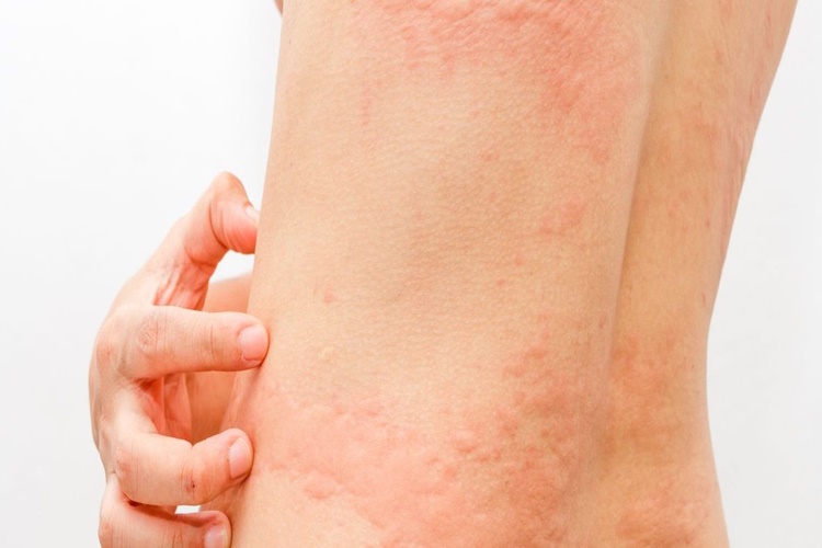 Bit Vücutta Kaşıntı Yapar Mı? - Güncel Oku