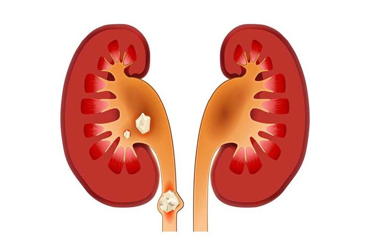 Böbrek Taşı Düşürürken Ne Yenmez? - Güncel Oku