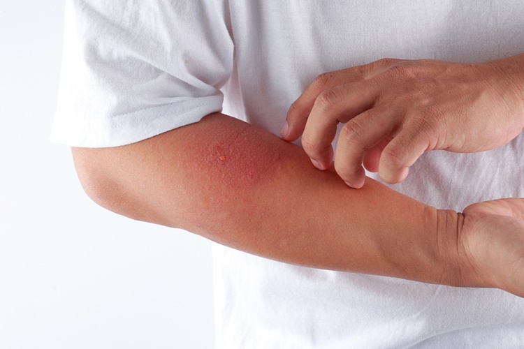 Cilt Kanseri Kaşıntı Yapar Mı? - Güncel Oku