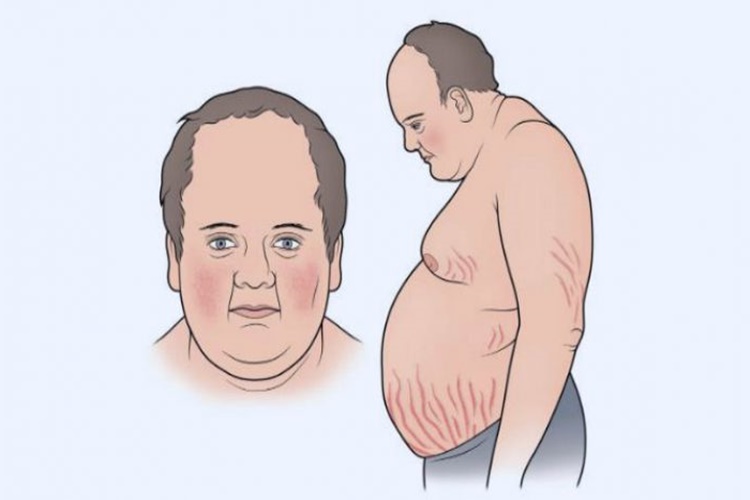 Cushing Hastalığı Nedir? - Güncel Oku