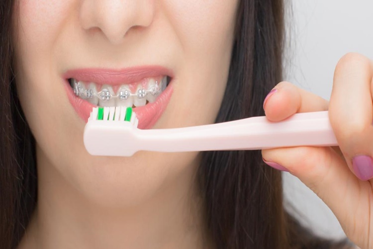 Diş Teli Varken Dişler Nasıl Fırçalanır? - Güncel Oku