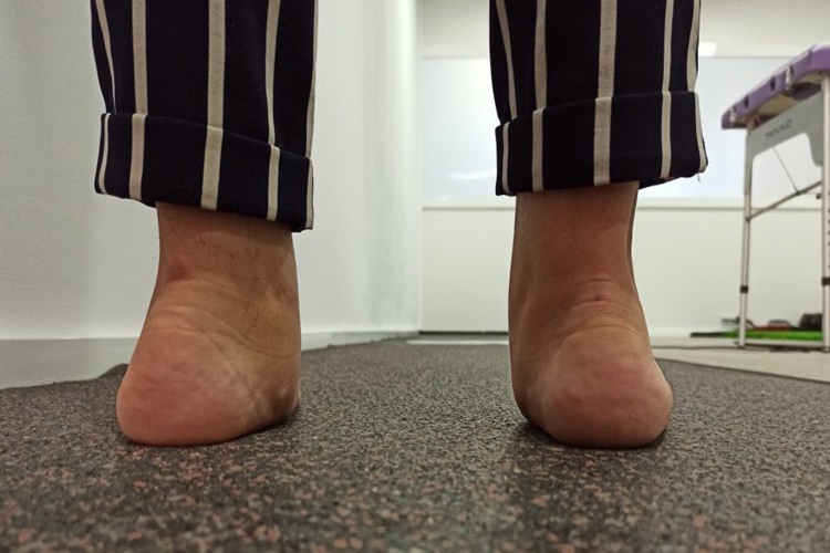 Flexible Pes Planus Polisliğe Engel Mi? - Güncel Oku