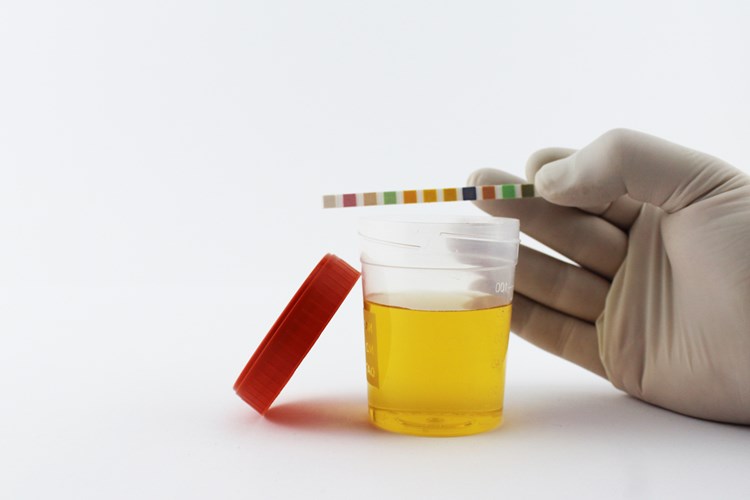 Folik Asit İdrar Rengini Değiştirir Mi? - Güncel Oku