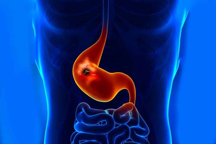 Gaviscon Double Action Ülsere İyi Gelir Mi? - Güncel Oku