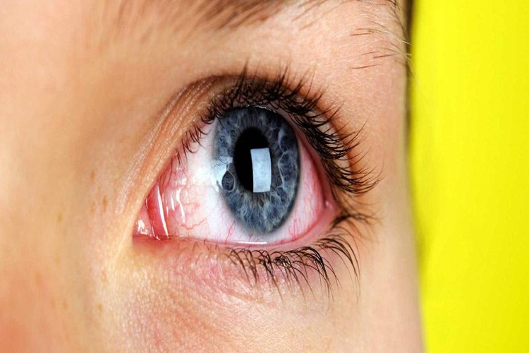 Göz Kuruluğu Arpacık Yapar Mı? - Güncel Oku