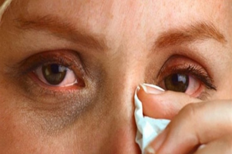 Gözde Yanma Ağızda Kuruluk Sebebi Nedir? - Güncel Oku