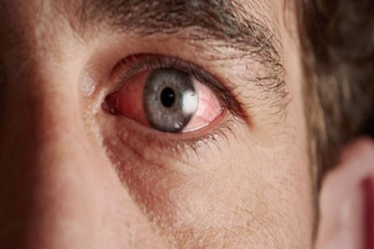 Gözde Yanma Burun Akıntısı Sebebi Nedir? - Güncel Oku