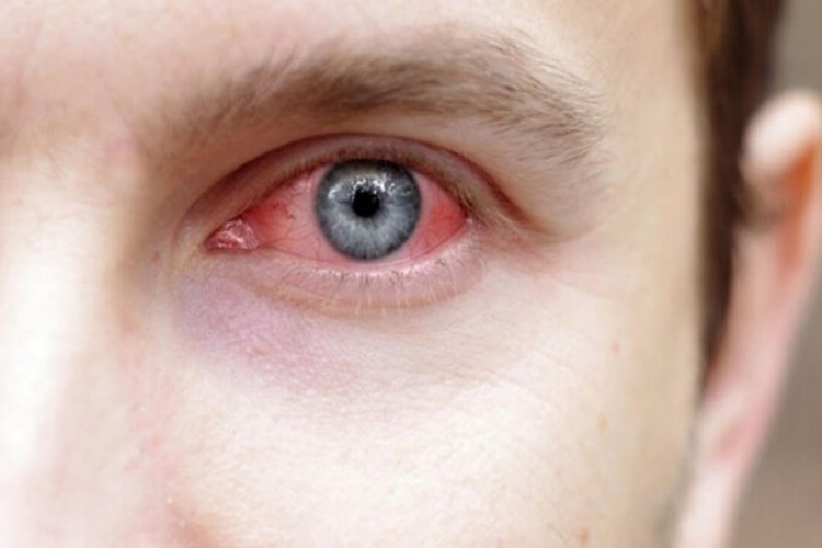 Gözde Yanma İçin Damla Önerileri Nelerdir? - Güncel Oku