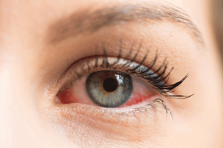 Gözde Yanma Nedenleri Nelerdir? - Güncel Oku