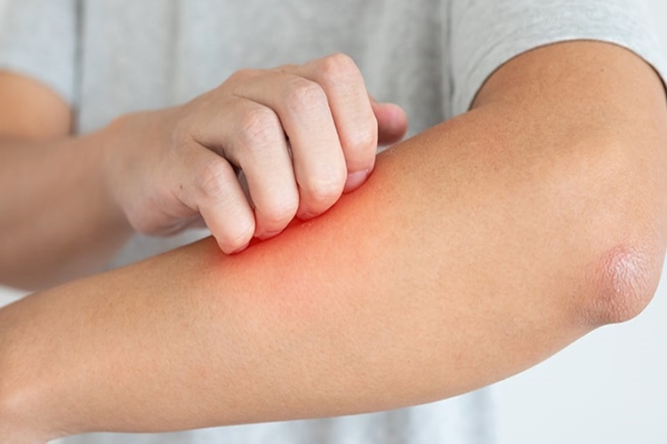 Gynoferon Kaşıntı Yapar Mı? - Güncel Oku