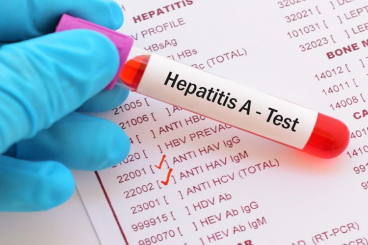 Hepatit A Nedir? - Güncel Oku