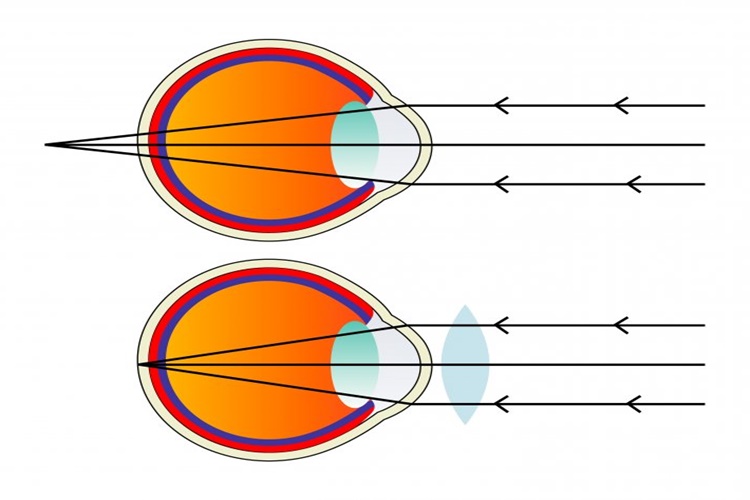 Hipermetropi Dolaşım Sistemi Hastalığı Mıdır? - Güncel Oku