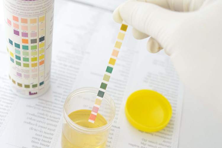 İdrar Rengi Açık Kırmızı Olmasının Sebebi Nedir? - Güncel Oku