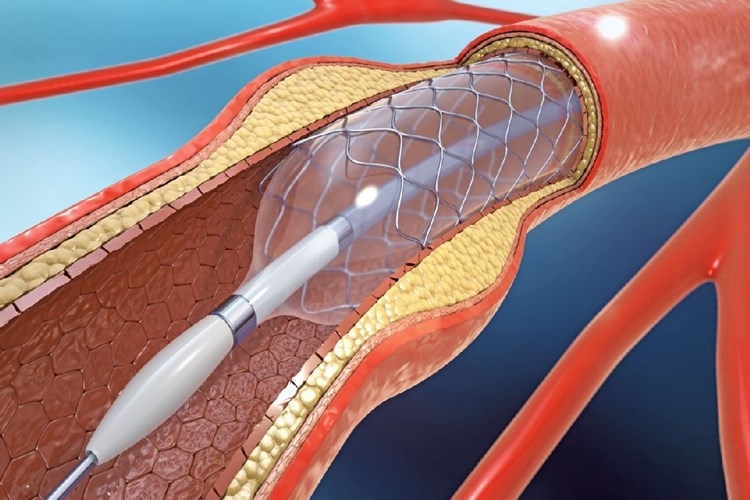 Kalbe 3 Stent Takılması Riskli Mi? - Güncel Oku