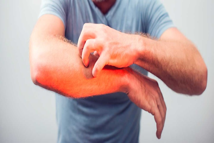 Kaşıntı İçin Hangi Krem İyi Gelir? - Güncel Oku