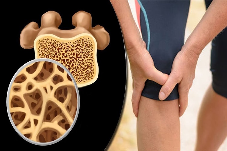 Kemik Erimesi Tedavisi Nasıl Olur? - Güncel Oku