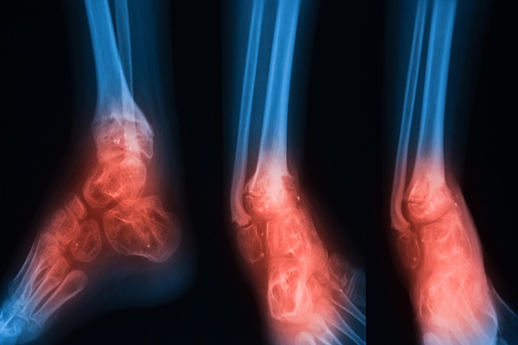 Kemik İltihabı Belirtileri Nelerdir? - Güncel Oku