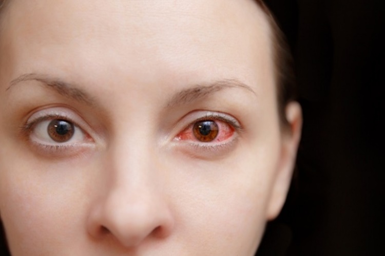 Koronavirüs Gözde Yanma Yapar mı? - Güncel Oku