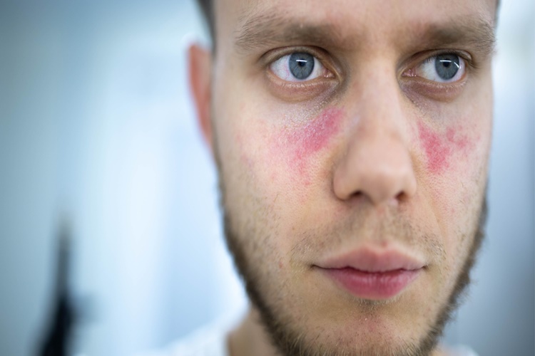 Lupus Belirtileri Nelerdir? - Güncel Oku