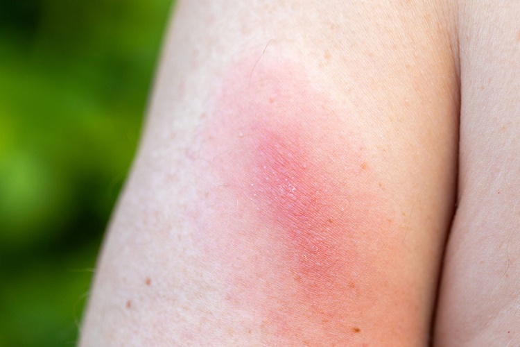 Lyme İgg/İgm Ab Nedir? - Güncel Oku