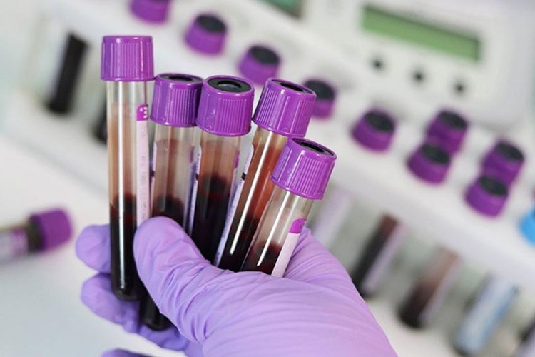 Lyme İgg Nedir? - Güncel Oku