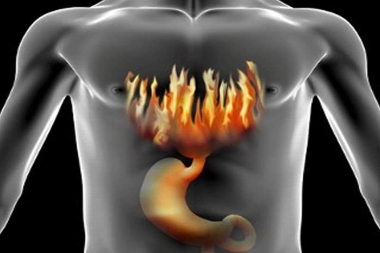 Mide Ekşimesi Hemen Nasıl Geçer? - Güncel Oku