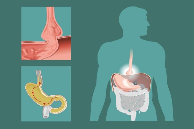 Mide Fıtığı Yasak Yemek Listesi Nedir? - Güncel Oku