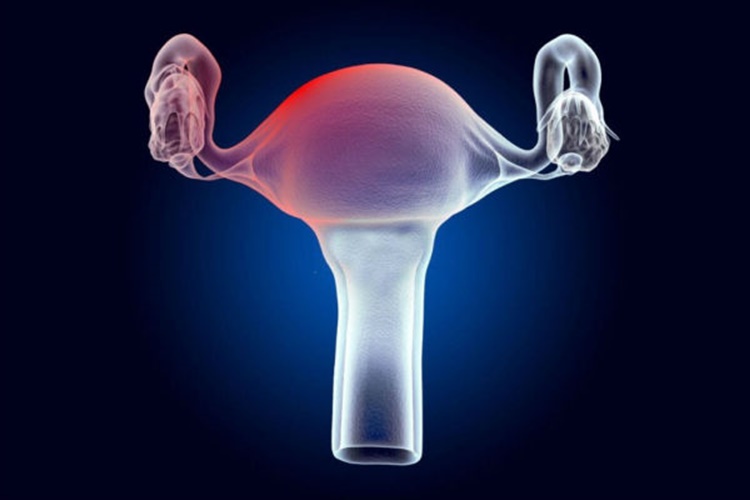 Miyom Cinsel İlişkiye Engel Mi? - Güncel Oku