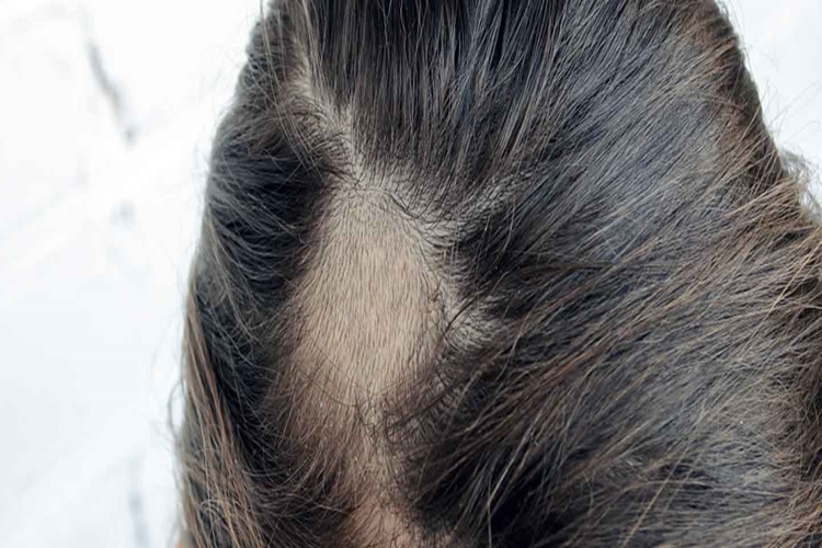 Momecon Losyon Saç Çıkarır Mı? - Güncel Oku