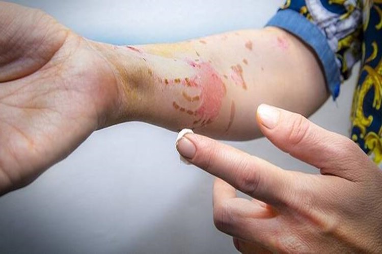 Momesalic Yanığa İyi Gelir Mi? - Güncel Oku