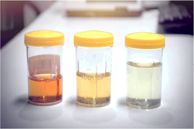 Multivitamin İdrar Rengini Değiştirir Mi? - Güncel Oku