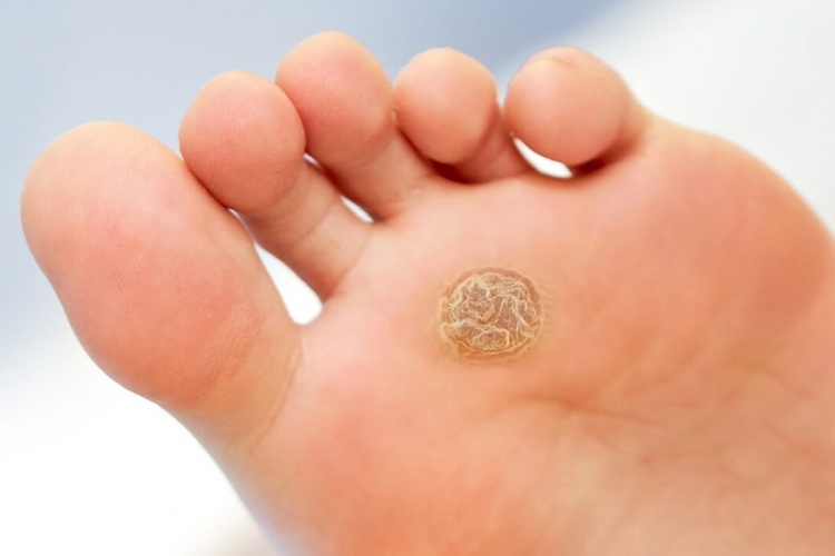 Nasır Ağrısı Nasıl Geçer? - Güncel Oku