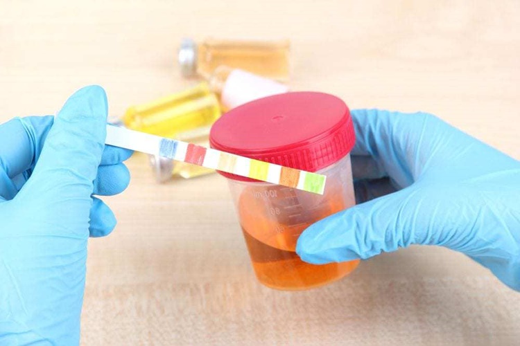 Ödem Atarken İdrar Rengi Nasıl Olur? - Güncel Oku