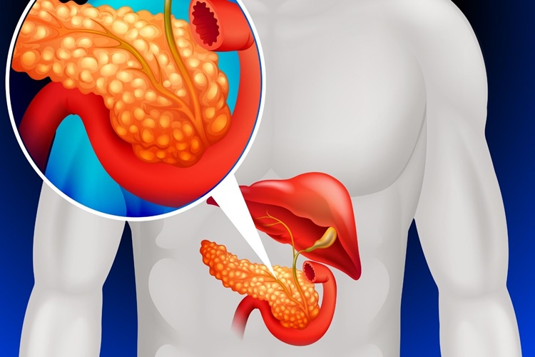Pankreatit Nasıl Tedavi Edilir? - Güncel Oku