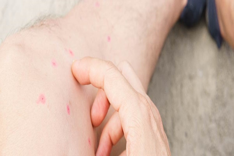 Pire Isırığı Nasıl Tedavi Edilir? - Güncel Oku