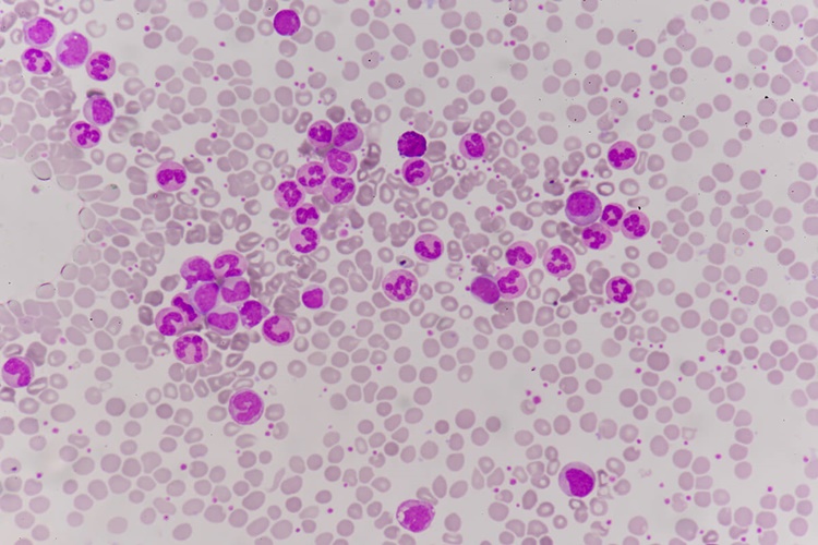 Planor 75 Mg Kan Sulandırır Mı? - Güncel Oku