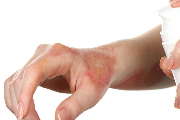 Prepagel Yanığa İyi Gelir Mi? - Güncel Oku