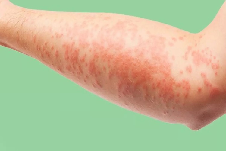 Pruzon Krem Gül Hastalığında Kullanılır Mı? - Güncel Oku