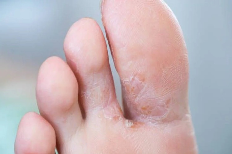 Pruzon Krem Mantara İyi Gelir Mi? - Güncel Oku