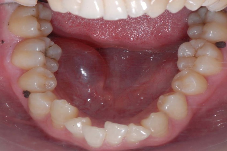 Ranula Nedir? - Güncel Oku