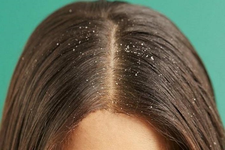 Saç Mantarı İçin Hangi Doktora Gidilir? - Güncel Oku